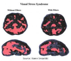 Visual Stress Syndrome Affects Most Students